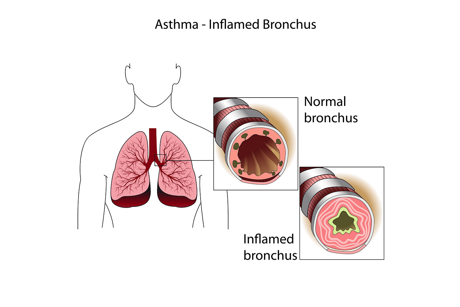What to Know About Biologic Medicines for Severe Asthma - Altus Biologics What to Know About Biologic Medicines for Severe Asthma - Altus Biologics